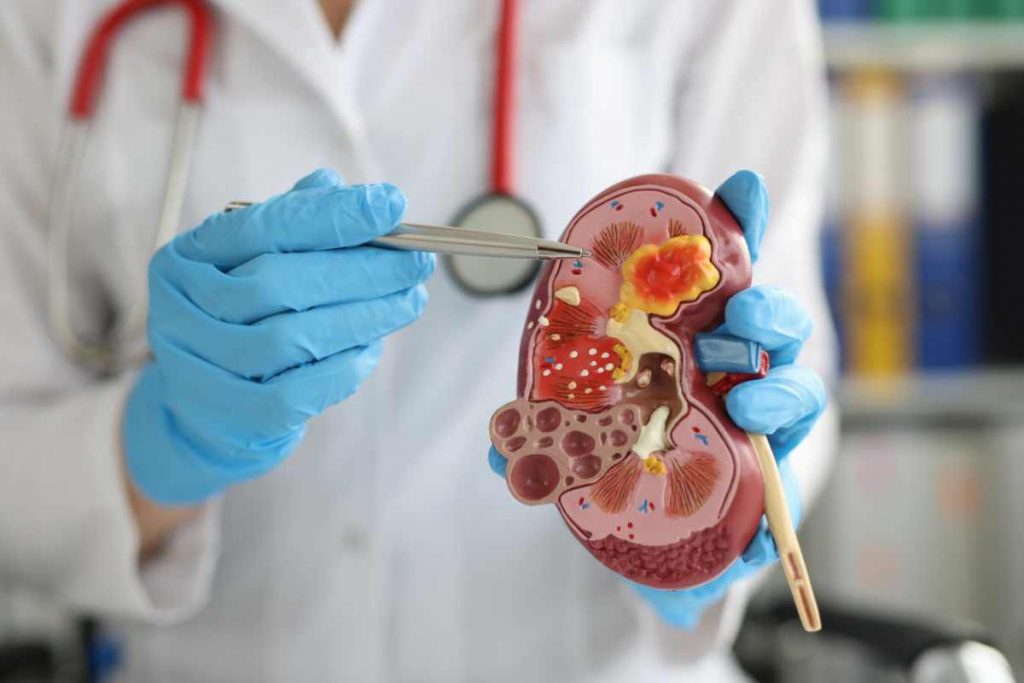 Tumore ai reni, quali sono i sintomi della malattia di cui soffriva ...